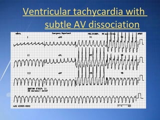 Ecg basic guidelines | PPT