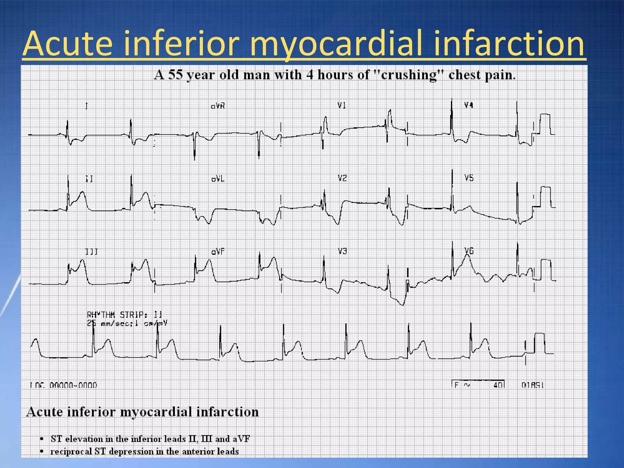 Ecg basic guidelines | PPT