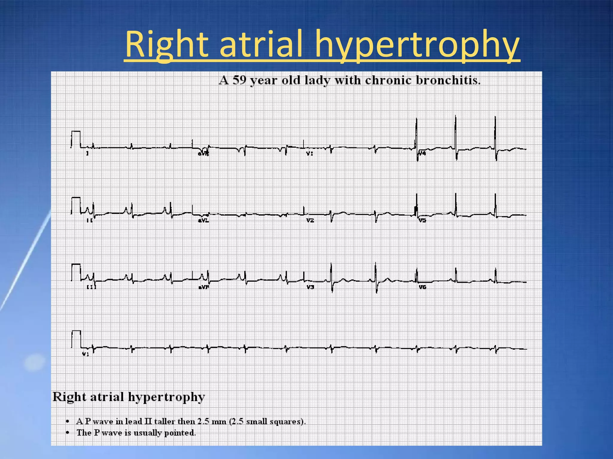 Ecg basic guidelines | PPT