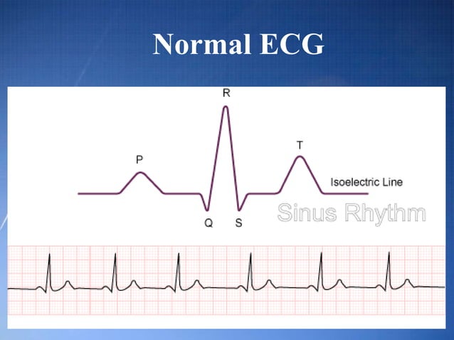 Ecg basic guidelines | PPT