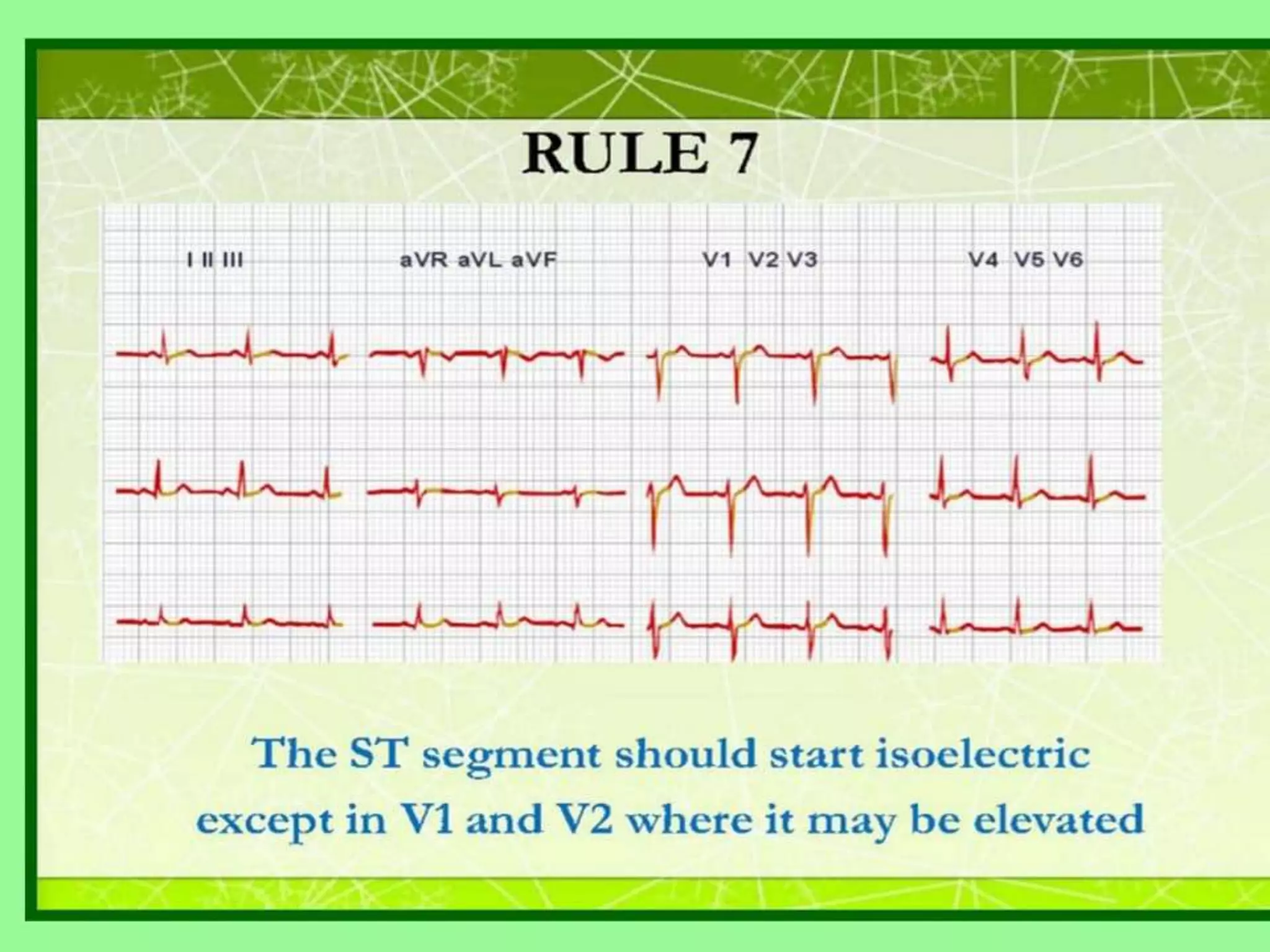Ecg basic rules | PDF