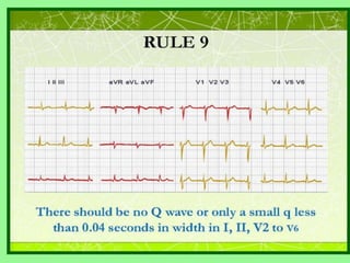 Ecg basic rules | PPT