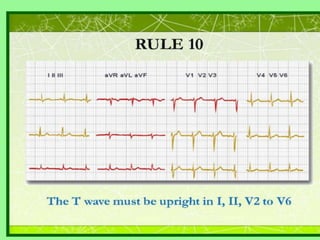 Ecg basic rules | PPT