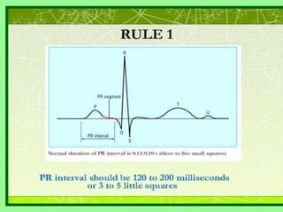 Ecg basic rules | PPT