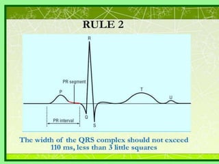 Ecg basic rules | PPT