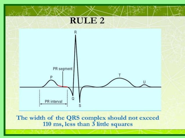 Ecg basic rules | PPT