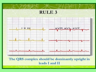 Ecg basic rules | PPT