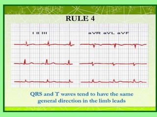 Ecg basic rules | PPT