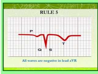 Ecg basic rules | PPT
