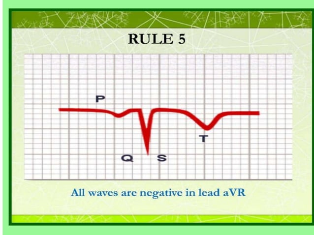 Ecg basic rules | PPT