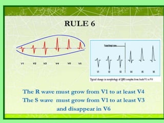 Ecg basic rules | PPT