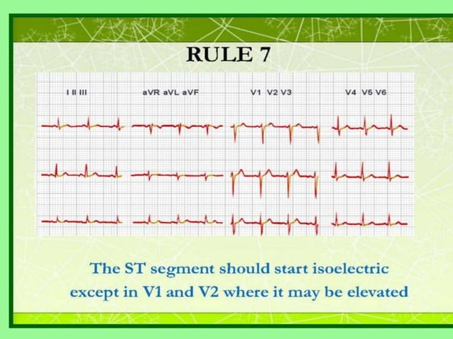 Ecg basic rules | PPT