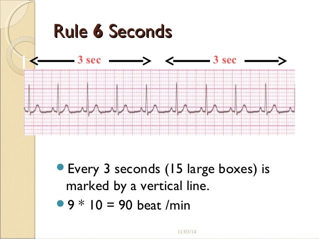 ECG Basics