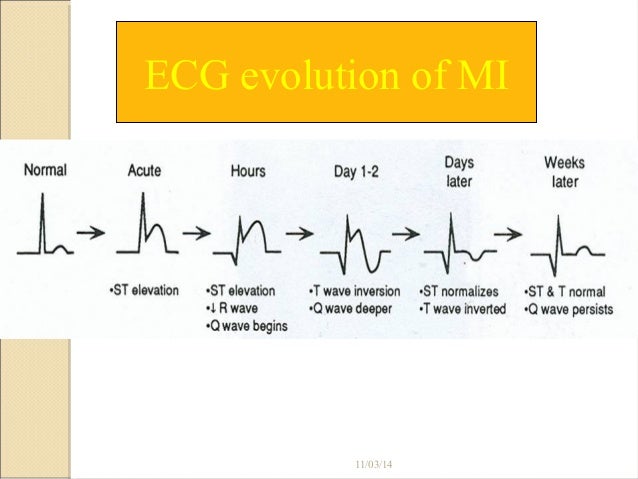 ECG Basics