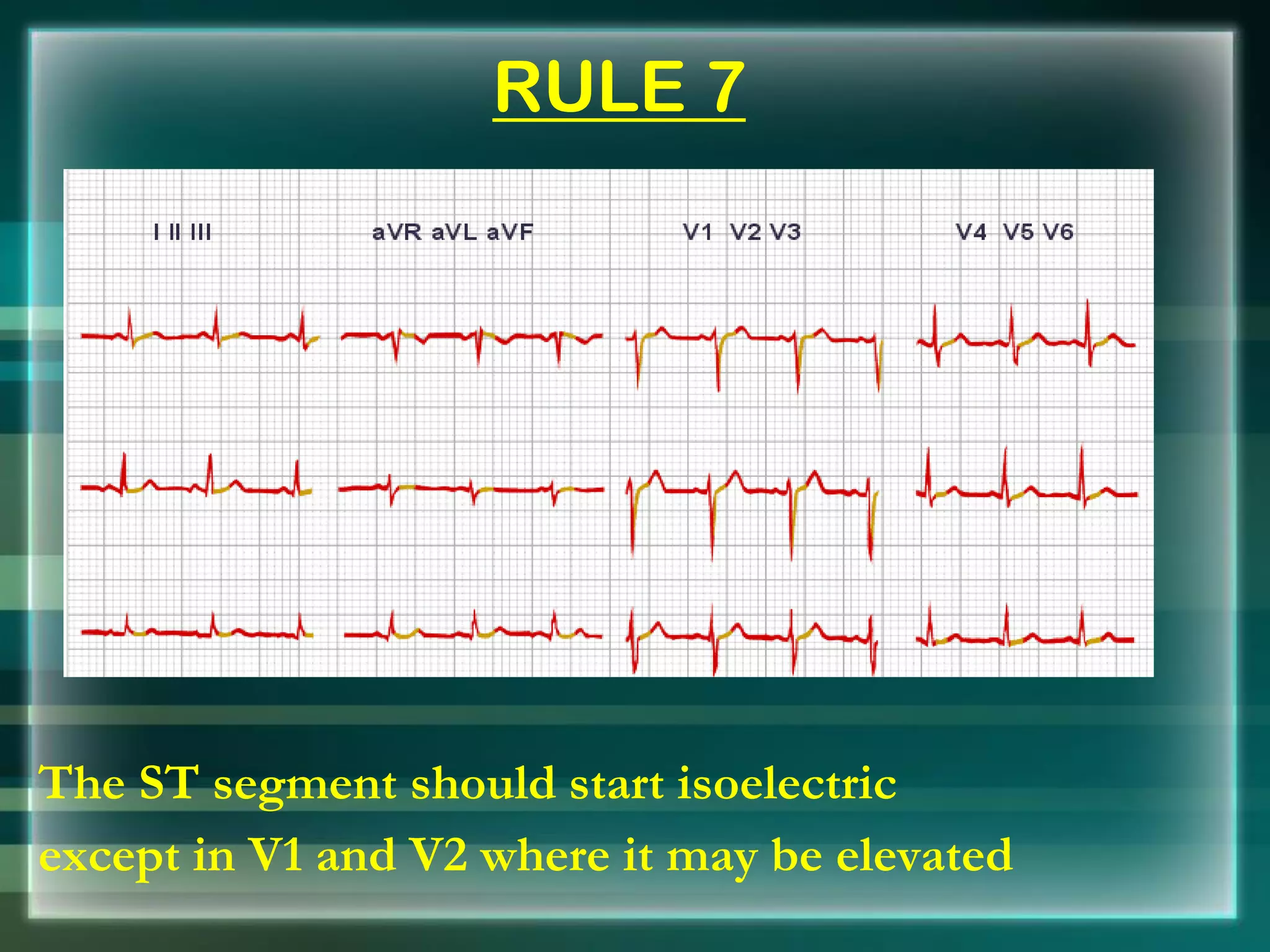 Ecg basics | PPT