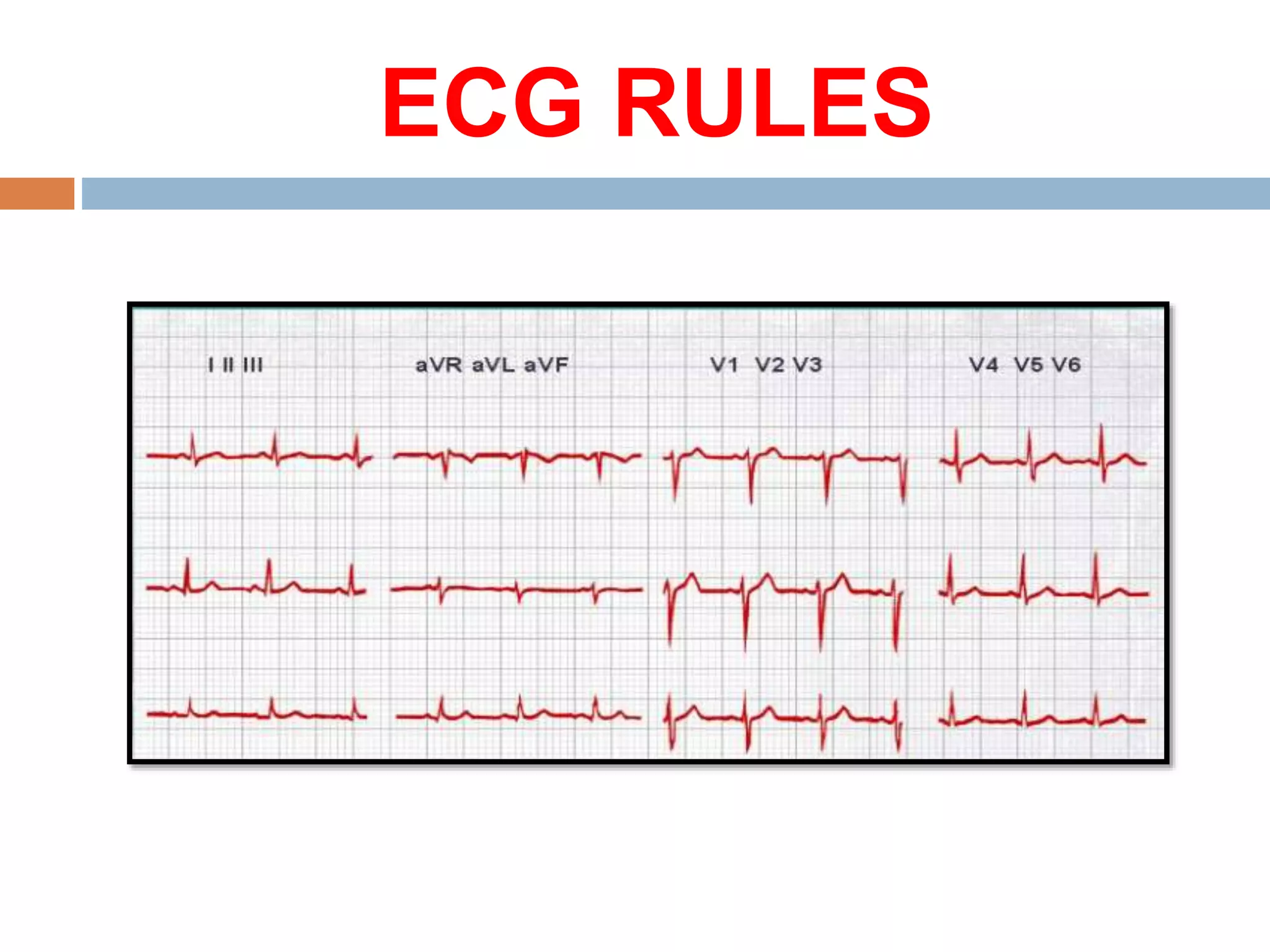 ECG basics.ppt | Heart and Cardiovascular Diseases | Diseases and Conditions