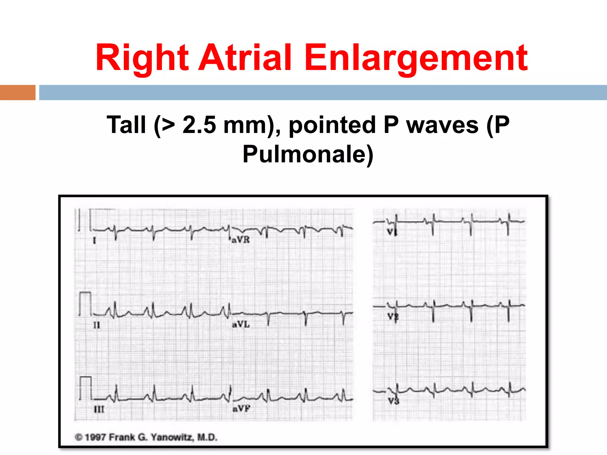 ECG basics.ppt | Heart and Cardiovascular Diseases | Diseases and ...