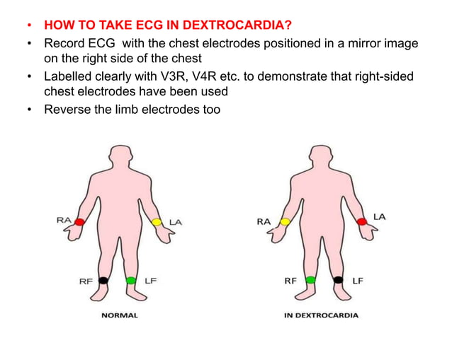 ECG BASICS , HOW TO TAKE ECG AND PLACEMENT OF LEADS | PPTX | Heart and ...