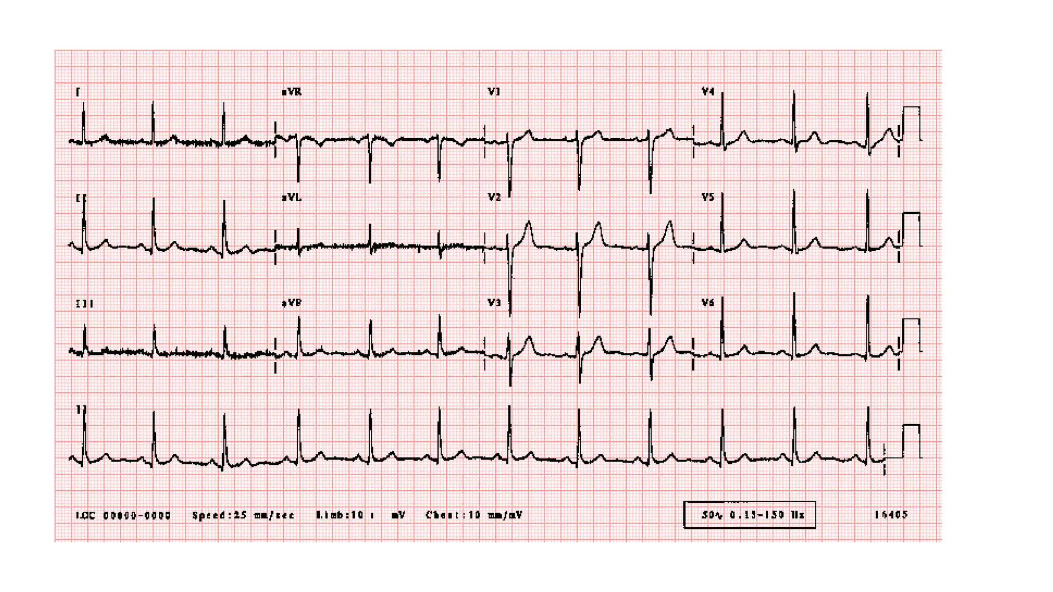 ecg basics for physiotherapy students reference purpose | PPTX