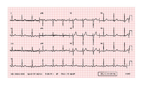 ecg basics for physiotherapy students reference purpose | PPTX | Heart ...