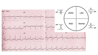 ecg basics for physiotherapy students reference purpose | PPTX