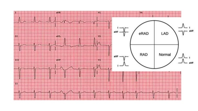 ecg basics for physiotherapy students reference purpose | PPTX | Heart ...