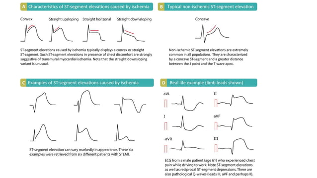 ecg basics for physiotherapy students reference purpose | PPTX | Heart ...