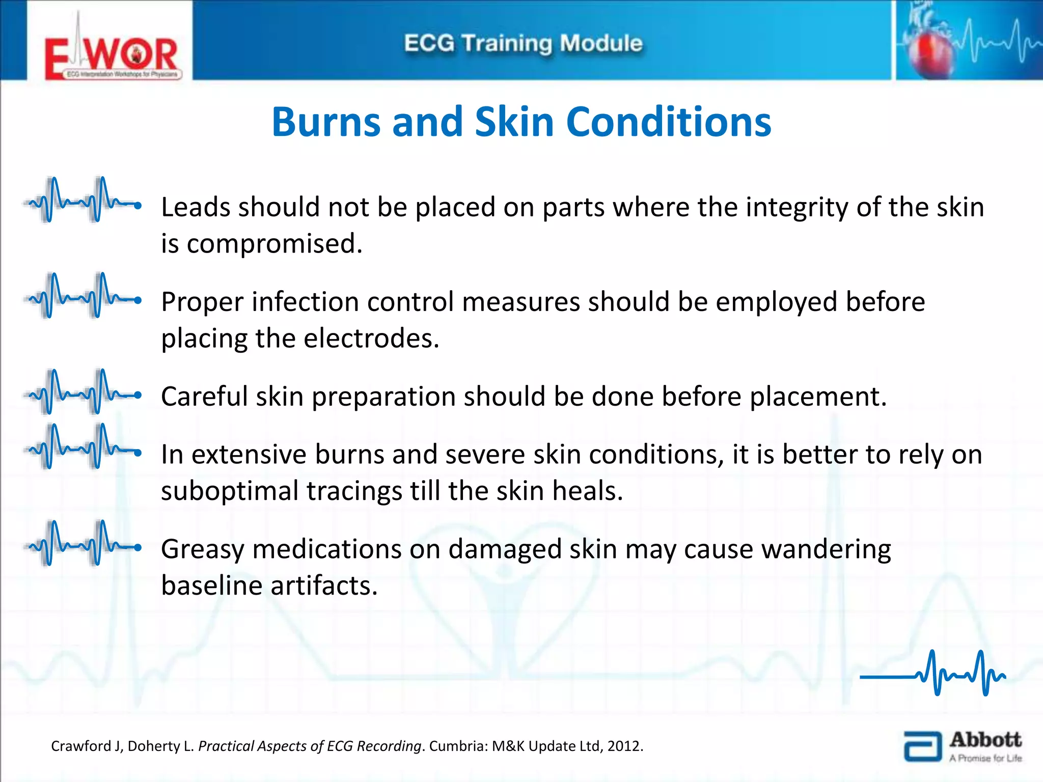 Ecg basics and interpretation | PPTX