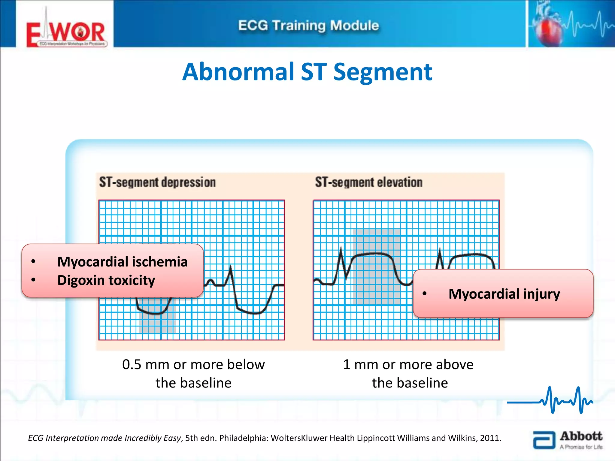 Ecg basics and interpretation | PPTX