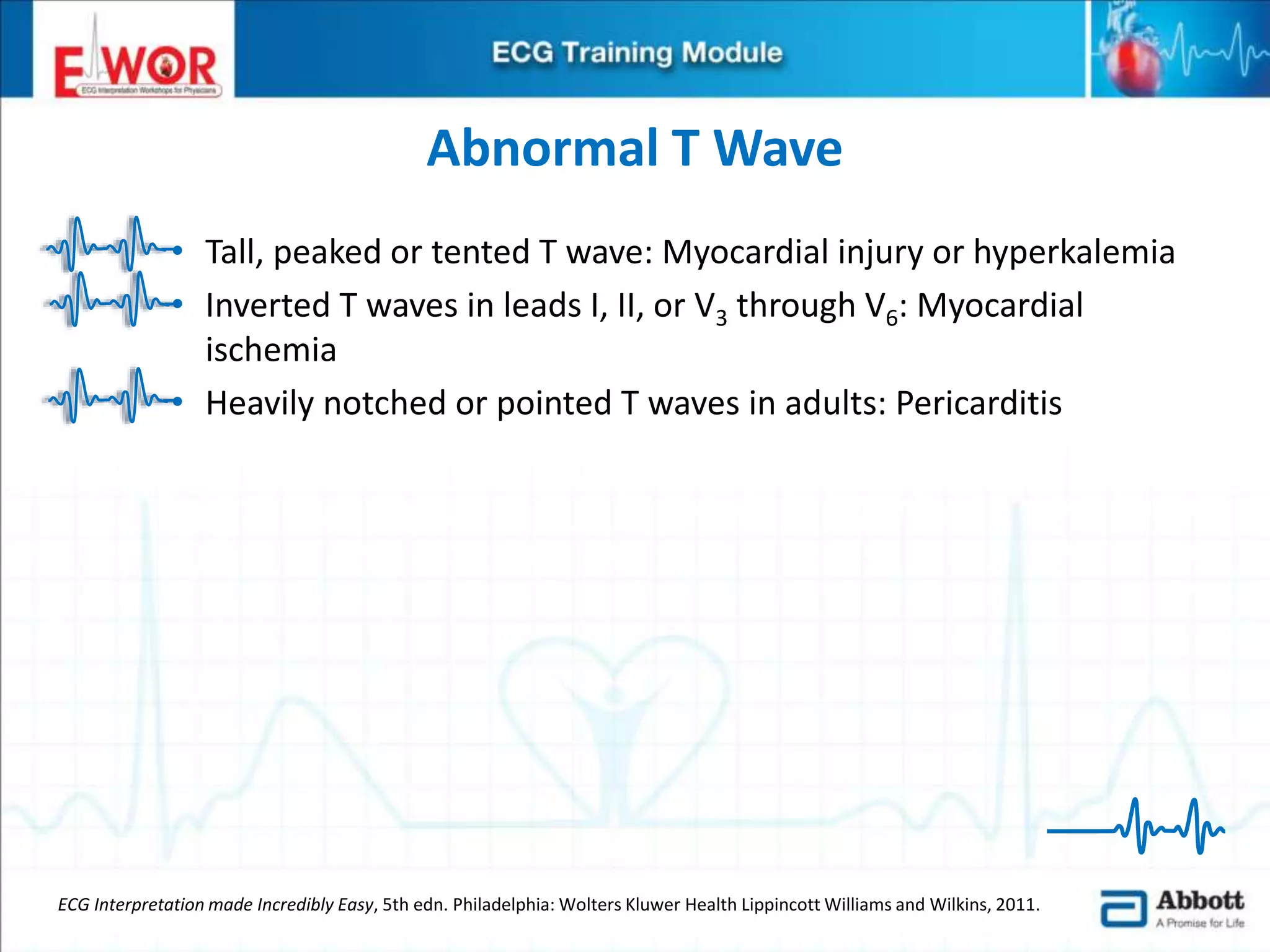 Ecg basics and interpretation | PPTX