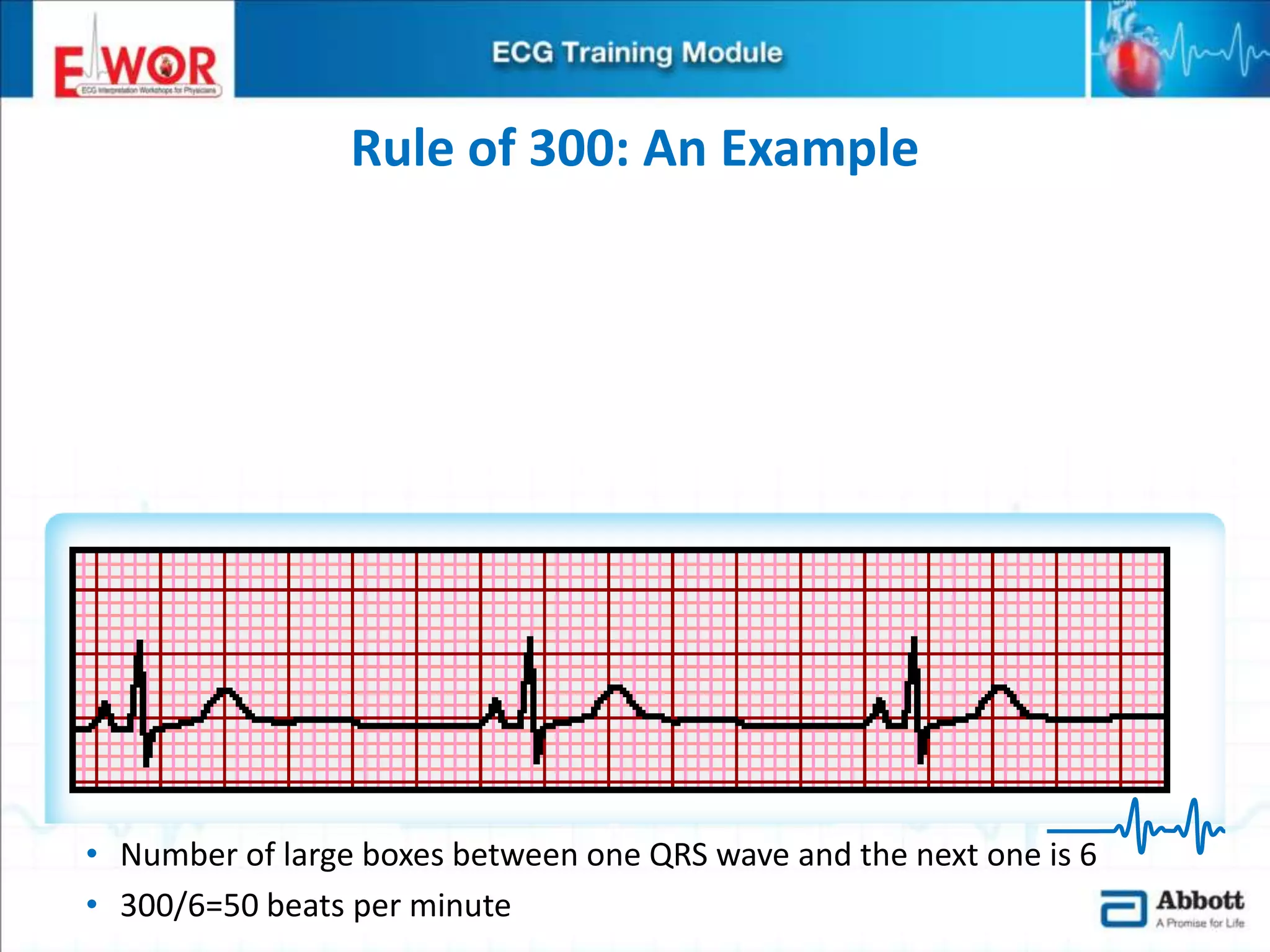Ecg basics and interpretation | PPTX