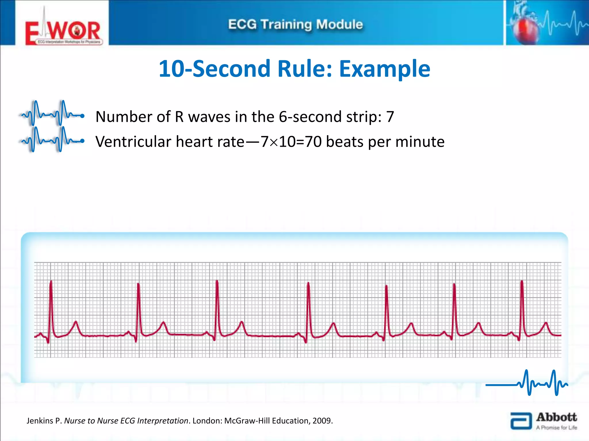 Ecg basics and interpretation | PPTX