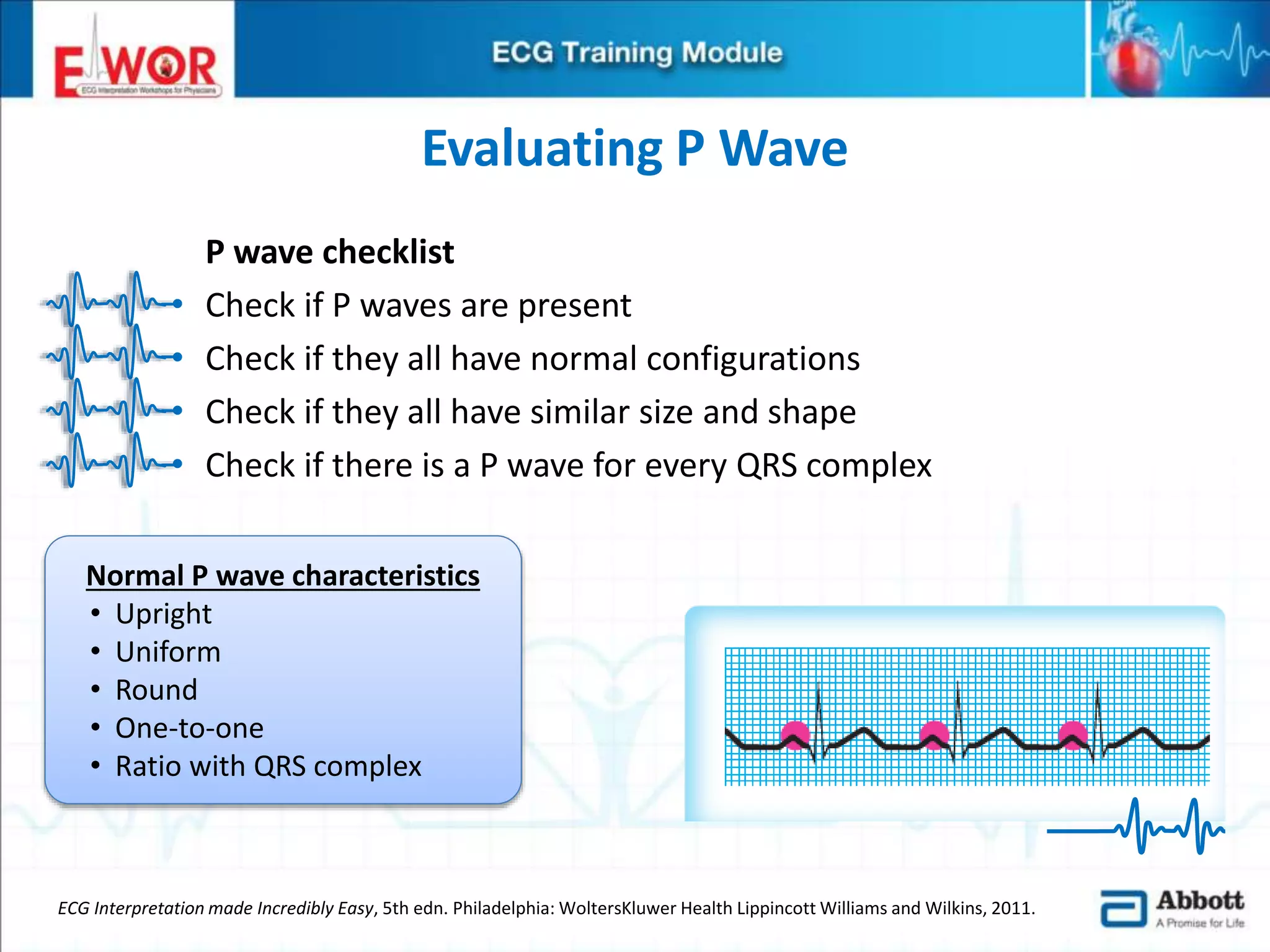 Ecg basics and interpretation | PPTX