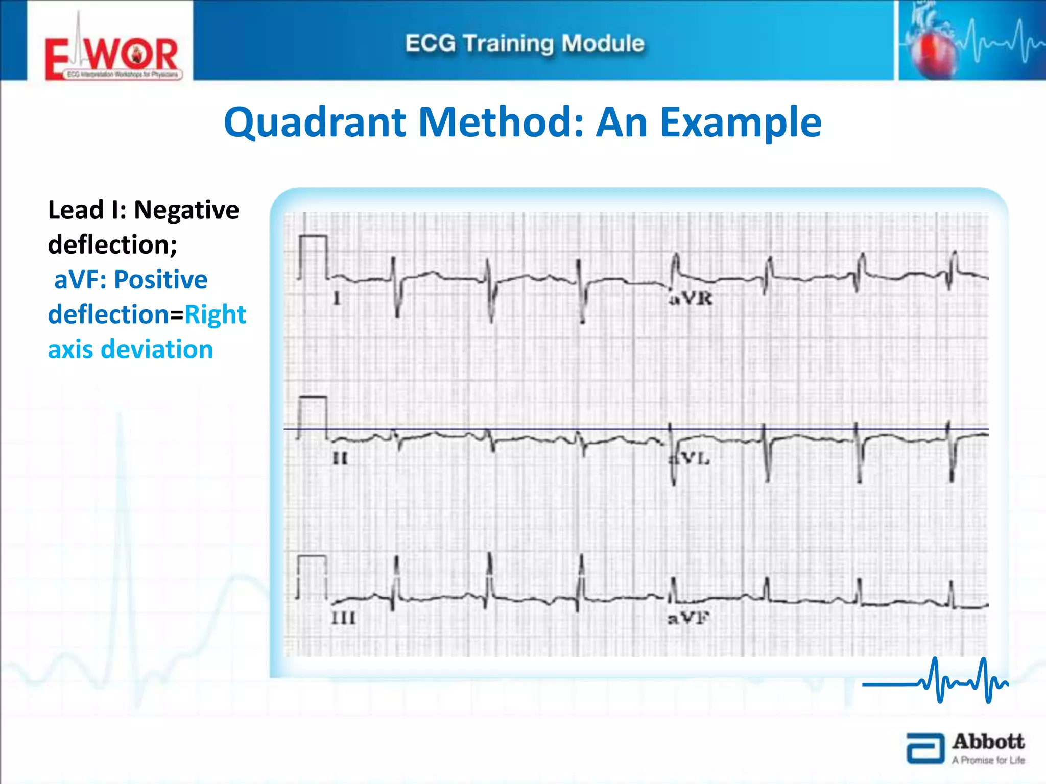 Ecg basics and interpretation | PPTX