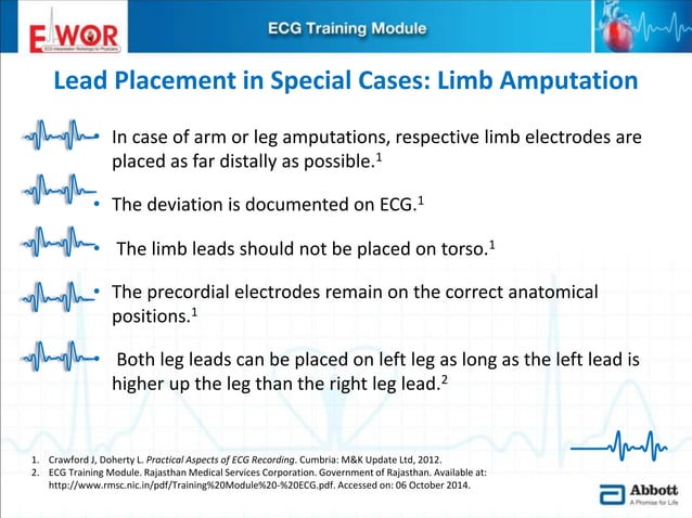 Ecg basics and interpretation | PPTX