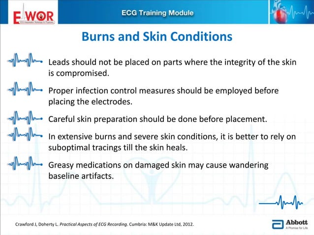 Ecg basics and interpretation | PPTX