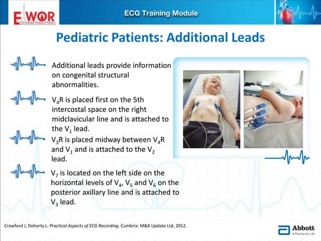 Ecg basics and interpretation | PPTX