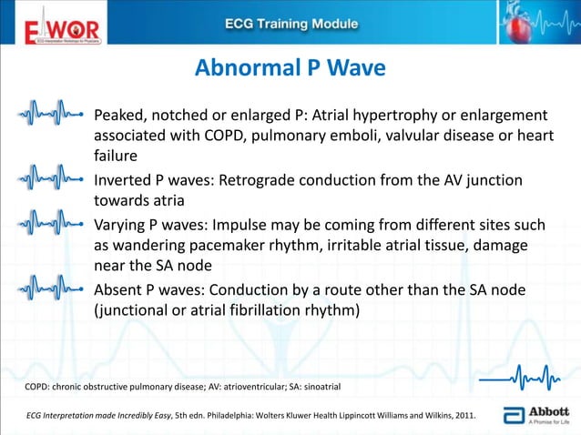 Ecg basics and interpretation | PPTX
