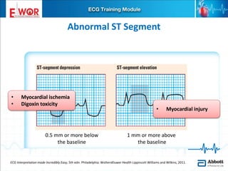 Ecg basics and interpretation | PPTX