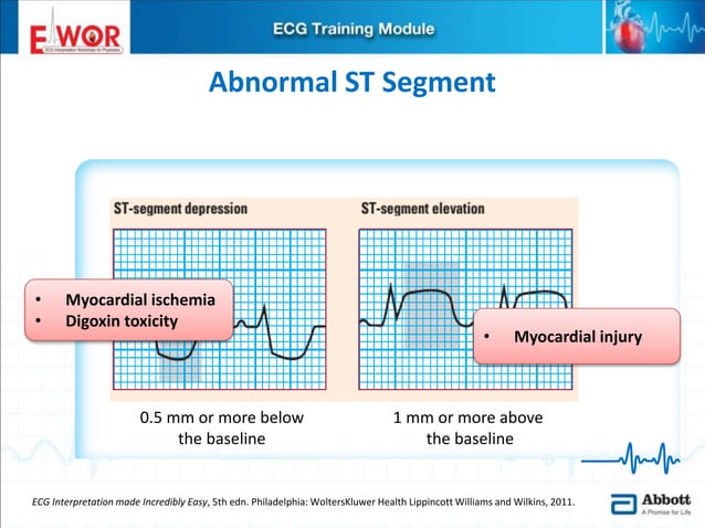 Ecg basics and interpretation | PPTX