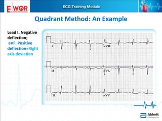 Ecg basics and interpretation | PPTX