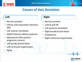 Ecg basics and interpretation | PPTX
