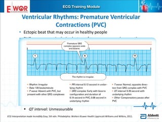 Ecg basics and interpretation | PPTX