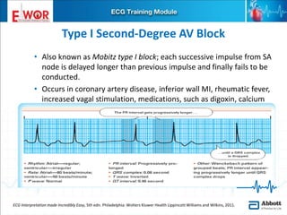Ecg basics and interpretation | PPTX