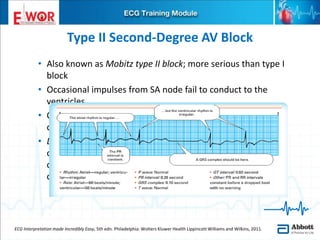 Ecg basics and interpretation | PPTX