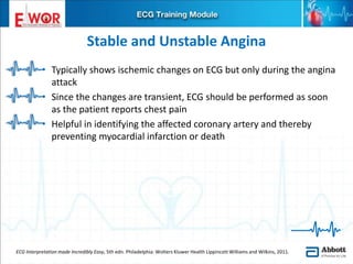 Ecg basics and interpretation | PPTX