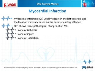 Ecg basics and interpretation | PPTX