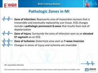 Ecg basics and interpretation | PPTX