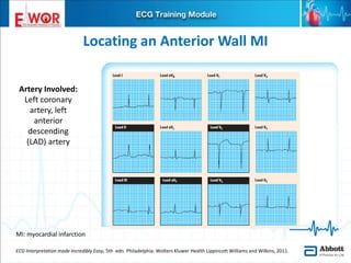 Ecg basics and interpretation | PPTX