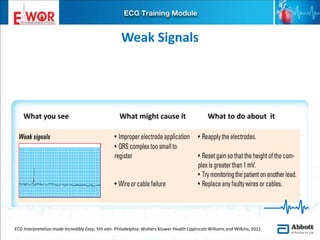 Ecg basics and interpretation | PPTX